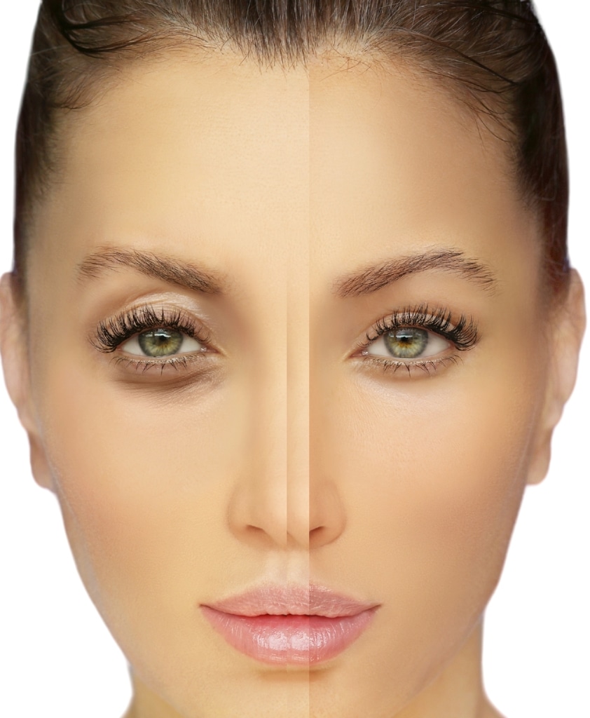 Tear Trough Treatment - Aesthetic Nurse Suzie